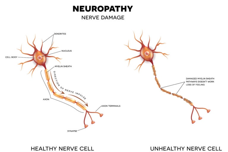 What is Alcoholic Neuropathy? - Healthier Steps