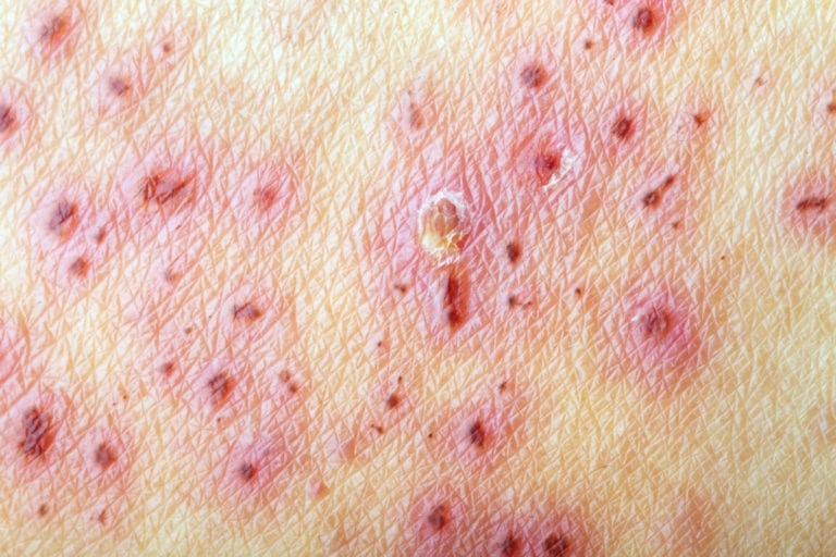 Shingles vs Chickenpox: What's the Difference? - Healthier Steps